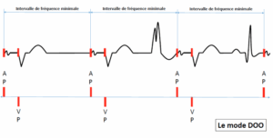 Pacemaker Pacing Modes: VVI, DDD, AAI, DDDR Explained | Cardiocases