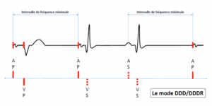 Traditional pacing modes - Cardiocases