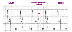 Medtronic MVP Mode: Managed Ventricular Pacing Explained | Cardiocases