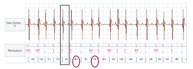 Abbott ICD SVT/VT Discrimination Guide | Cardiocases